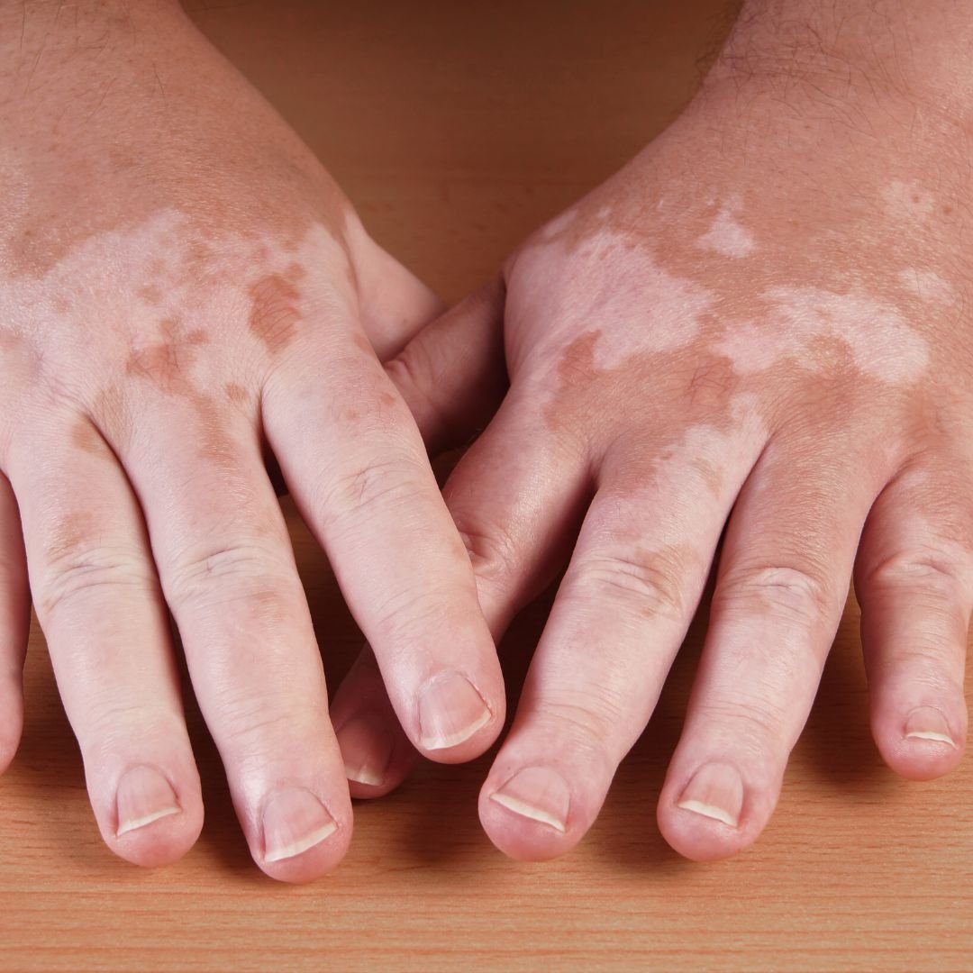 Top Conditions Lymphatic Drainage Therapy Can Benefit – Rhemedy By Rhed